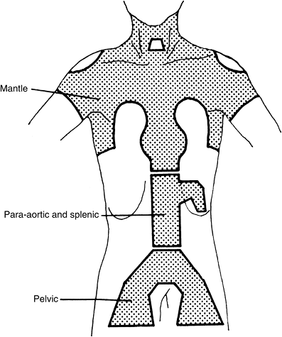Radiation Therapy: Mantle Field Radiation Therapy
